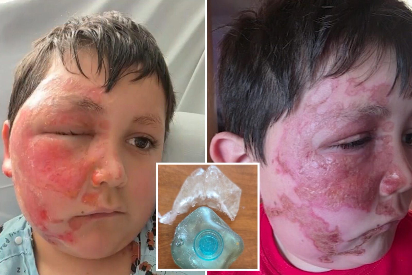 Boy, 9, severely burned after microwaving NeeDoh sensory toy in ...